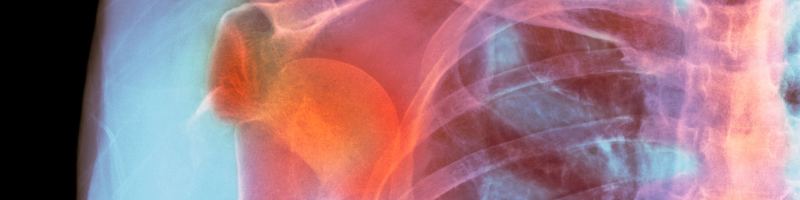 Tratamientos conservadores para la lesión del manguito rotador sin ...